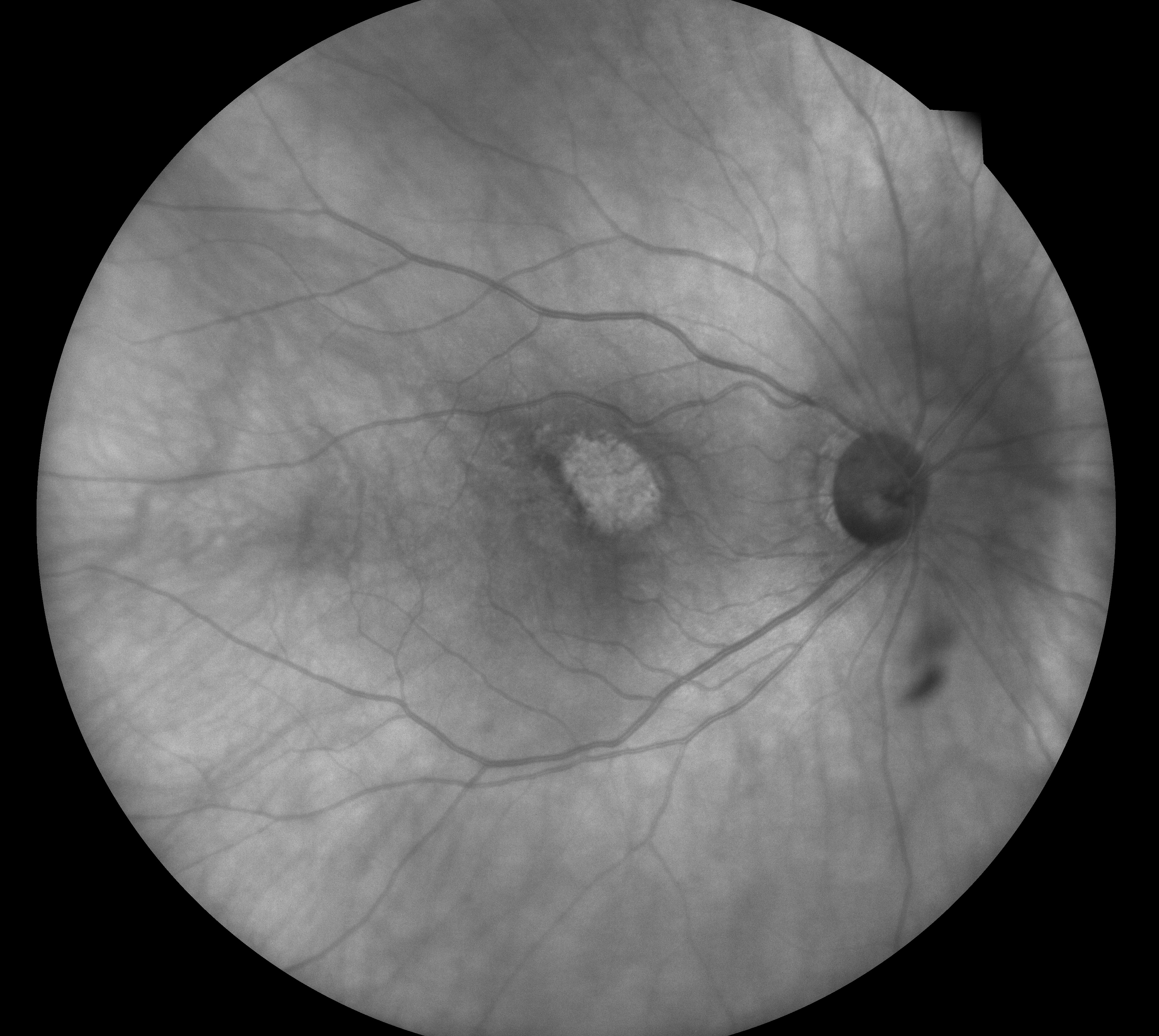 Ir Imaging Retina And Eidon